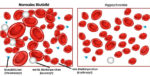 ᐅ Hypochrome Anämie (Hypochromie): Ursachen dieser Blutarmut
